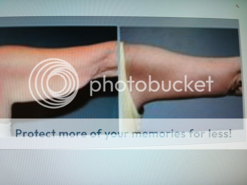 Vulvoplasty Videos | Photobucket